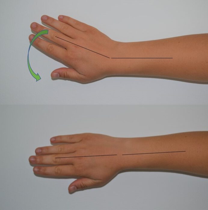 Rheuma – rheumatoide Arthritis - Physio Bosse